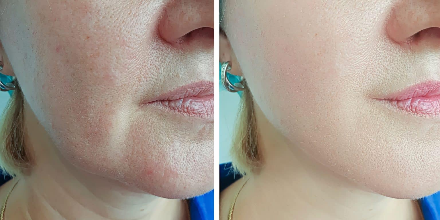 What Is the Difference Between Profhilo and Fillers? | OneHealth.sg ...