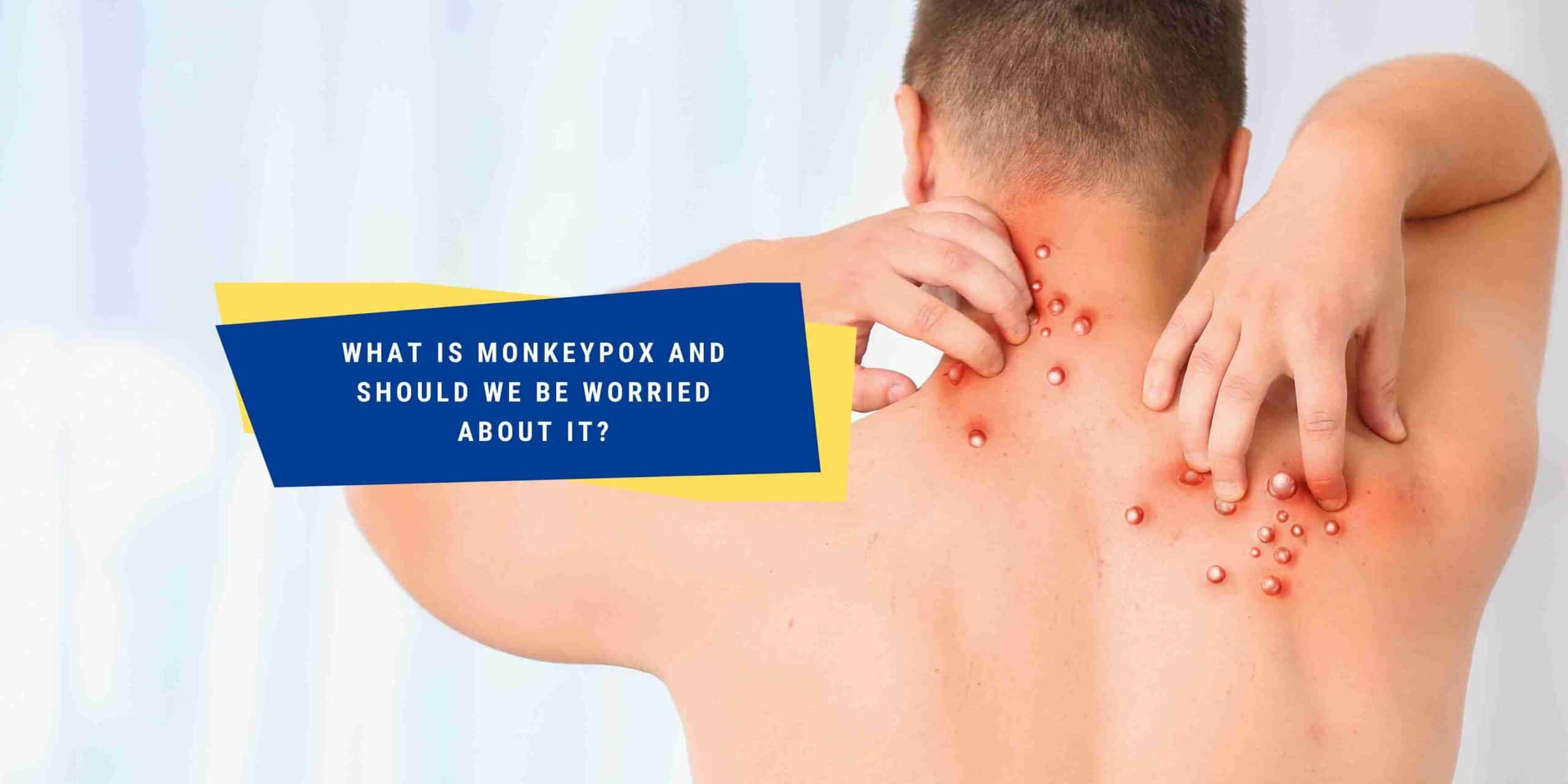 What Is Monkeypox? - Everything You Need To Know | OneHealth.sg ...
