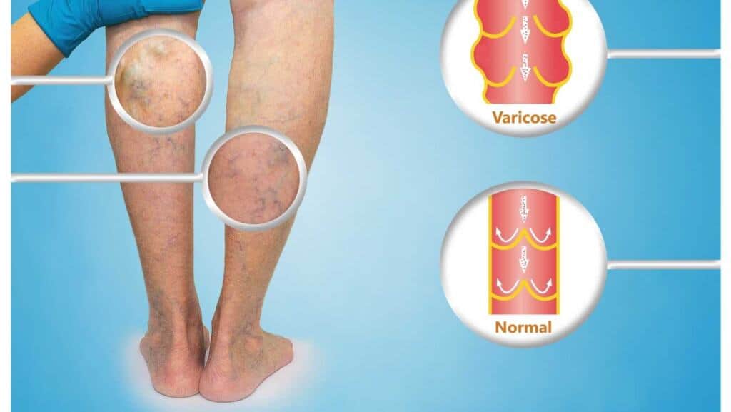 Varicose Vein Therapy -How It Works & When To See A Doctor