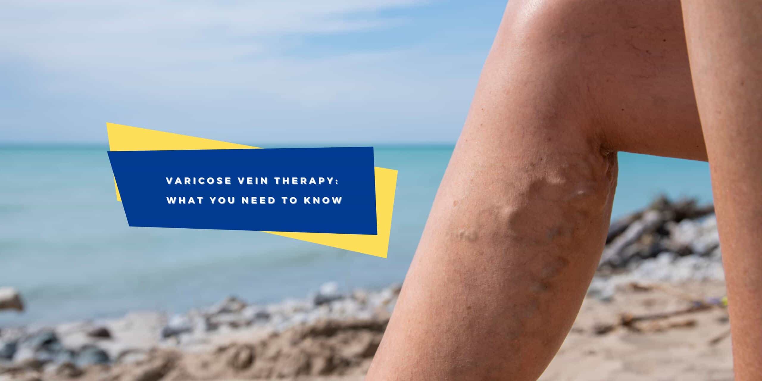 Varicose Vein Therapy -How It Works & When To See A Doctor