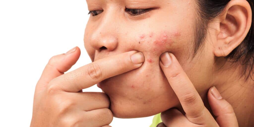 What Isotretinoin Actually Does To Your Skin