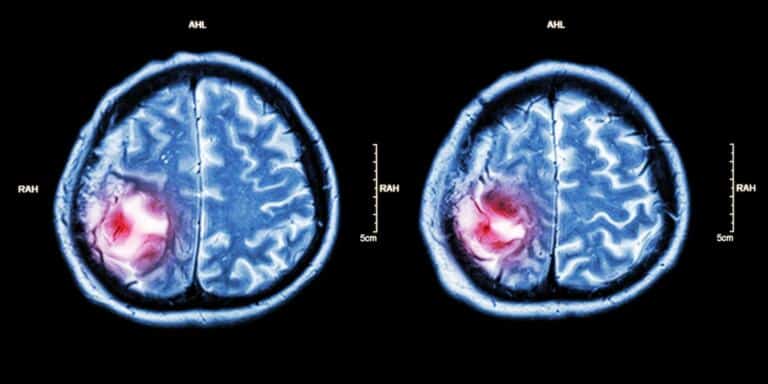 Signs and Symptoms of a Highly Malignant Brain Tumor