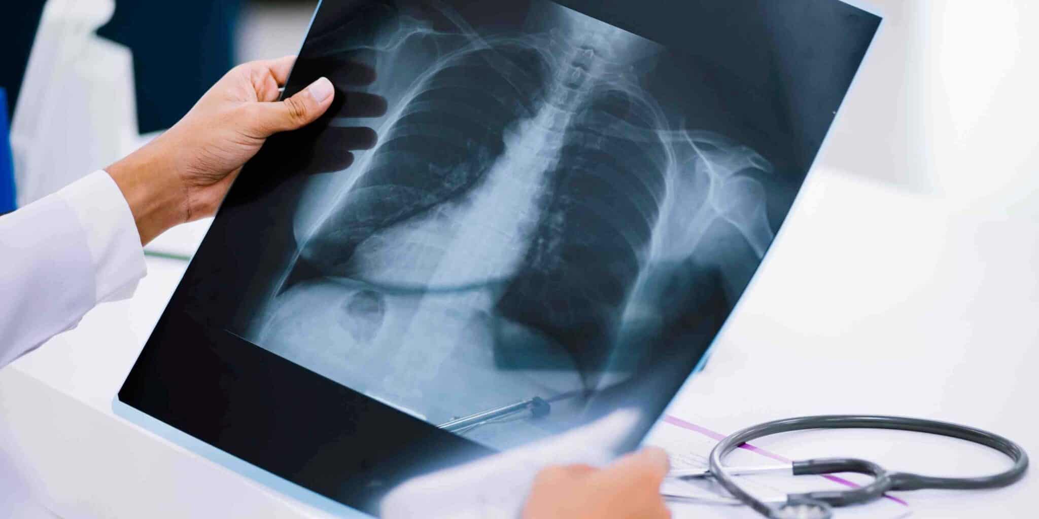 Uncovering the Different Types of Persistent Cough and Its Treatments