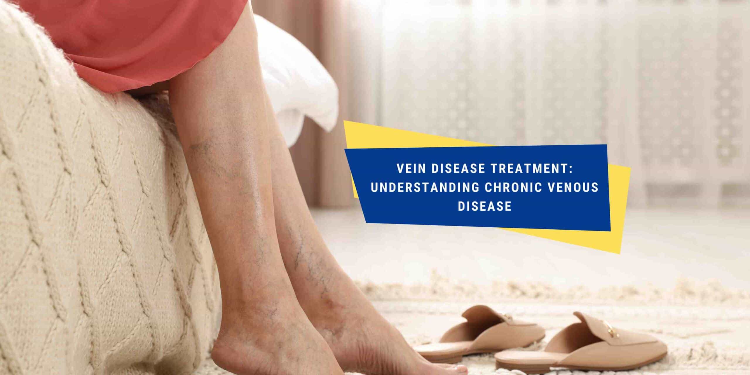Vein Disease Treatment: Understanding Chronic Venous Disease ...