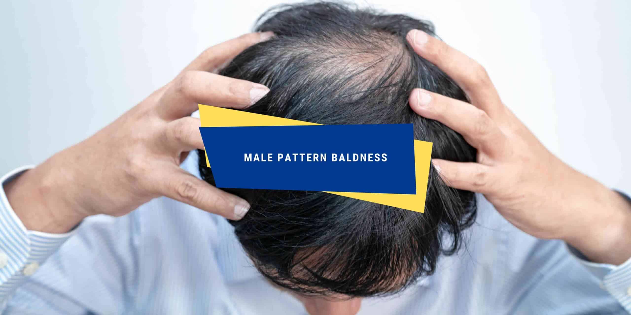 Male Pattern Baldness